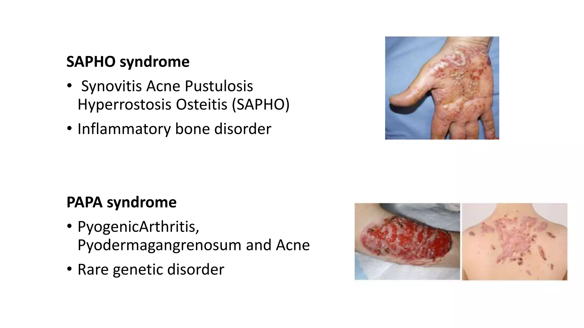 Acne vulgaris | PPTX