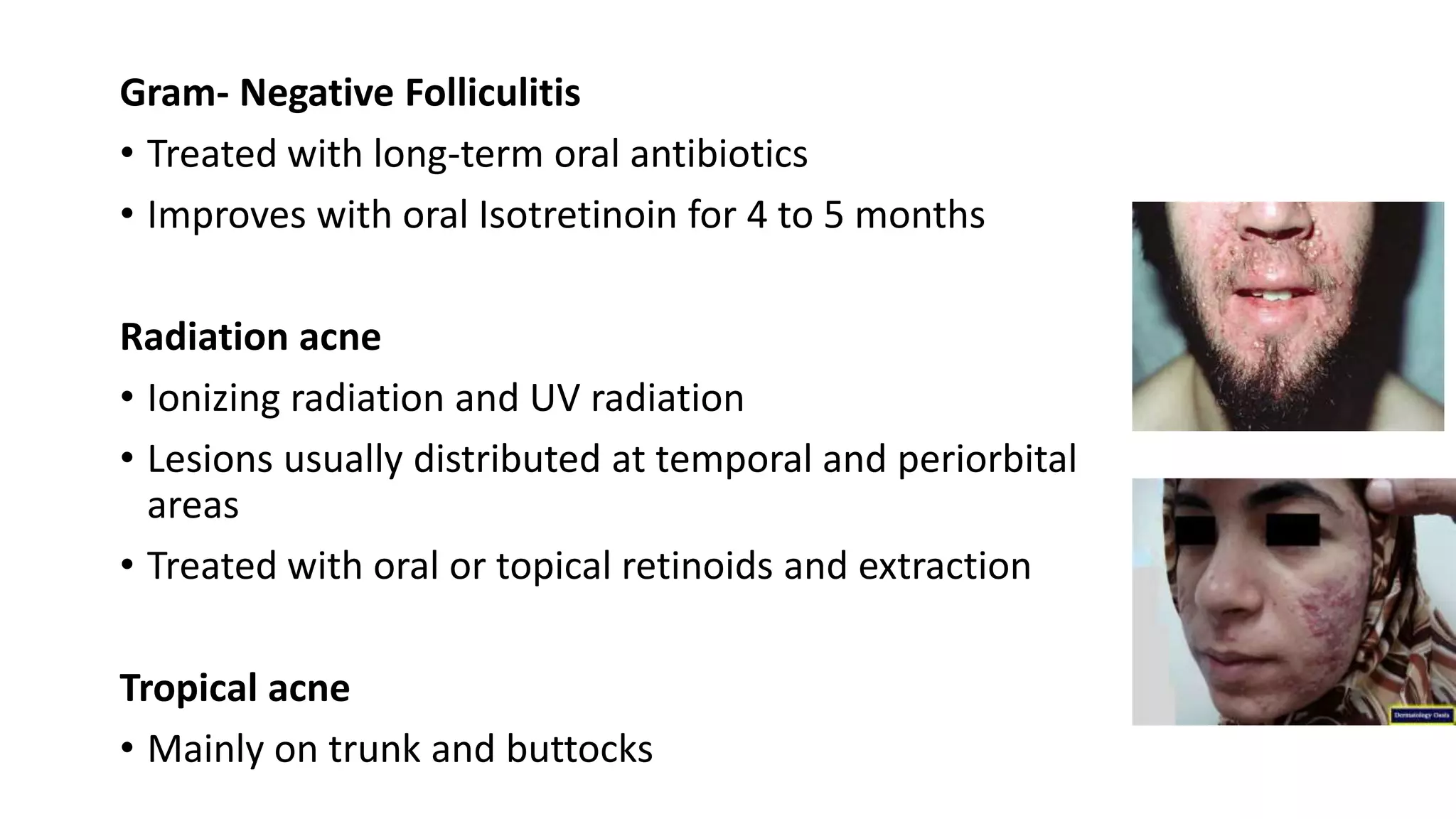 Acne vulgaris | PPTX