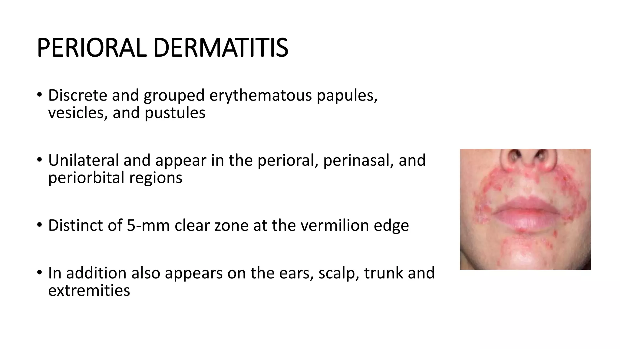 Acne vulgaris | PPTX