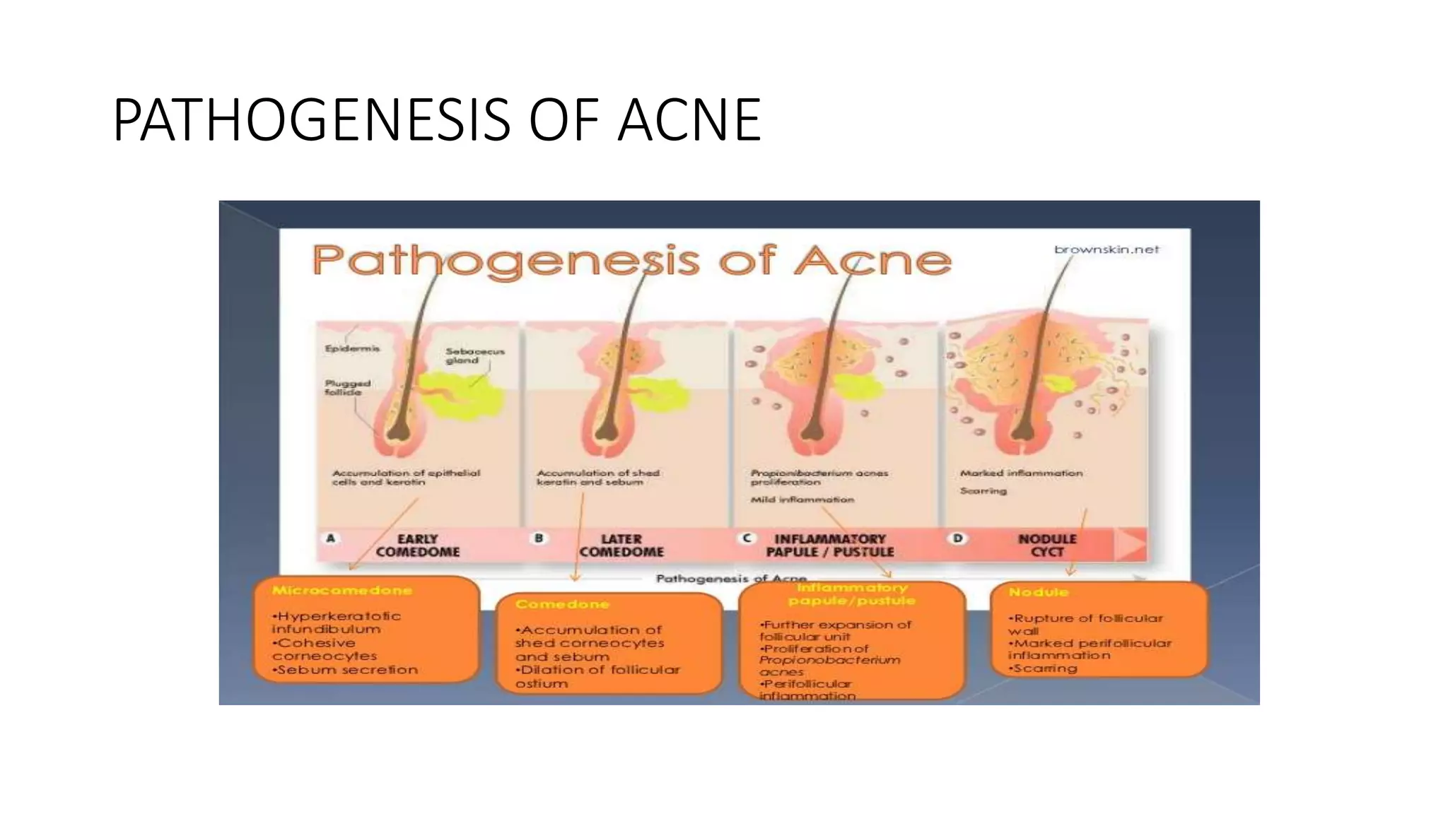 Acne vulgaris | PPTX