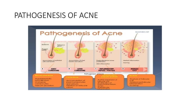 Acne vulgaris | PPTX | Skin and Dermatology | Diseases and Conditions
