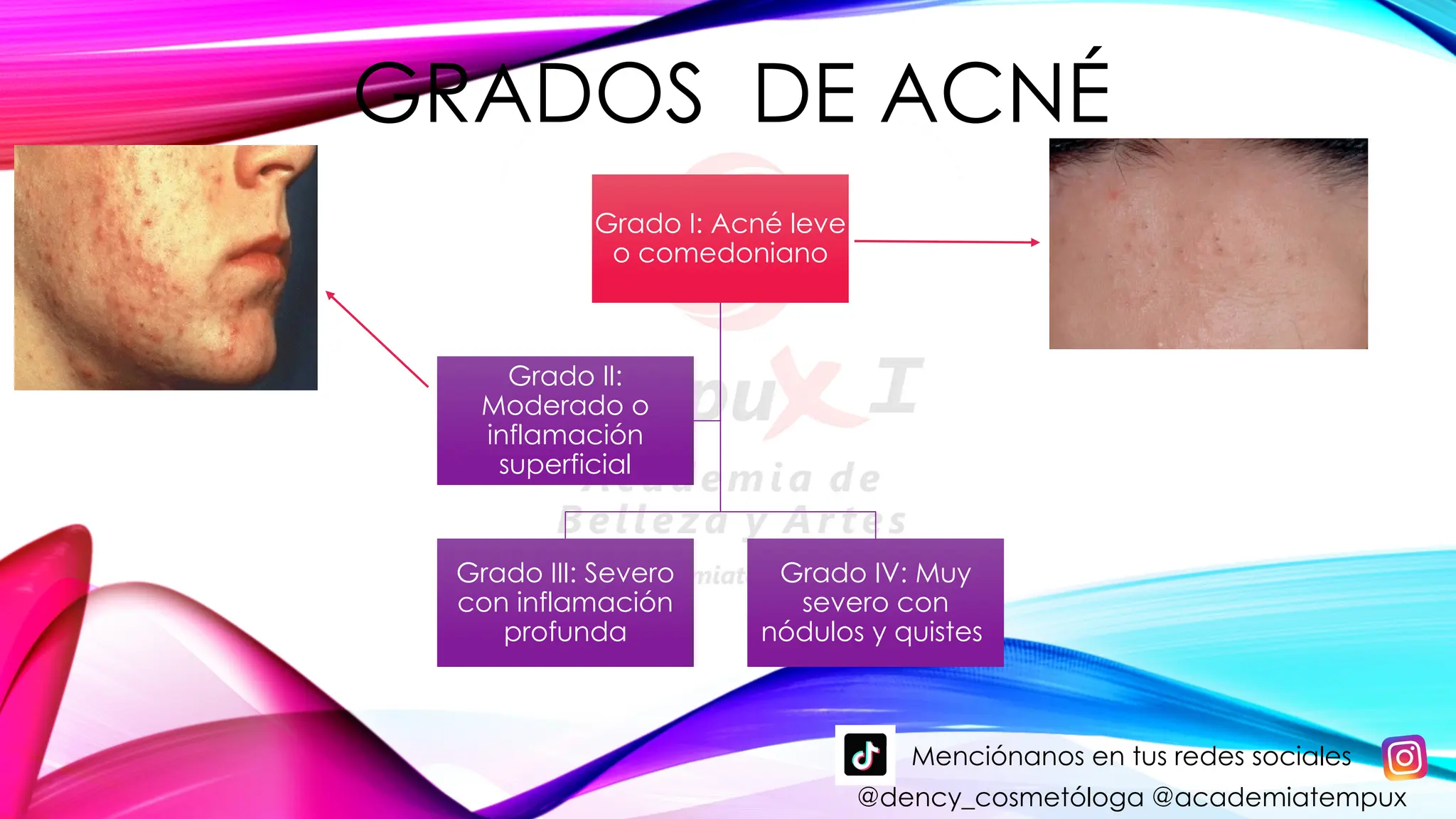 ACNE Y SUS TIPOS el estudio de la piel en diagnósticos | PPTX