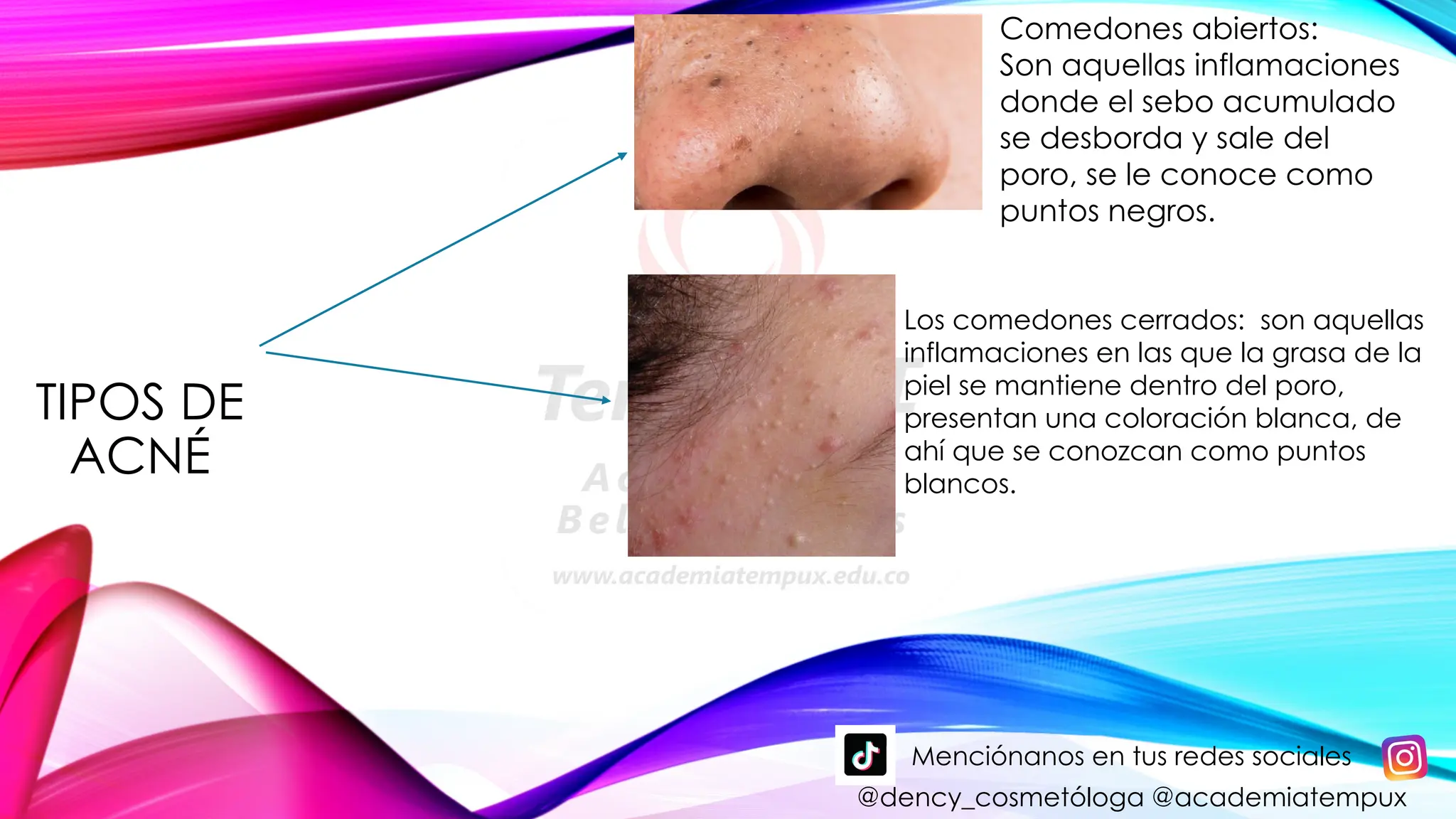 ACNE Y SUS TIPOS el estudio de la piel en diagnósticos | PPTX
