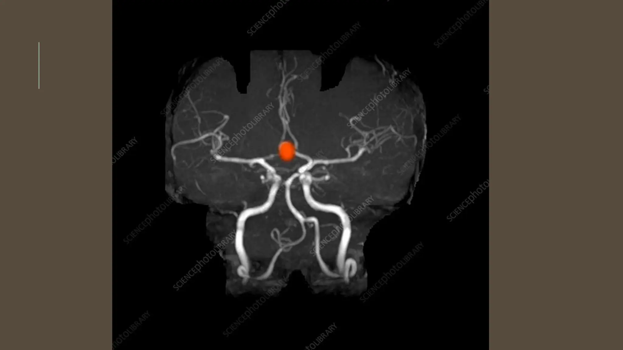 ACOM ANEURYSM Presentation slide share.. | PPTX