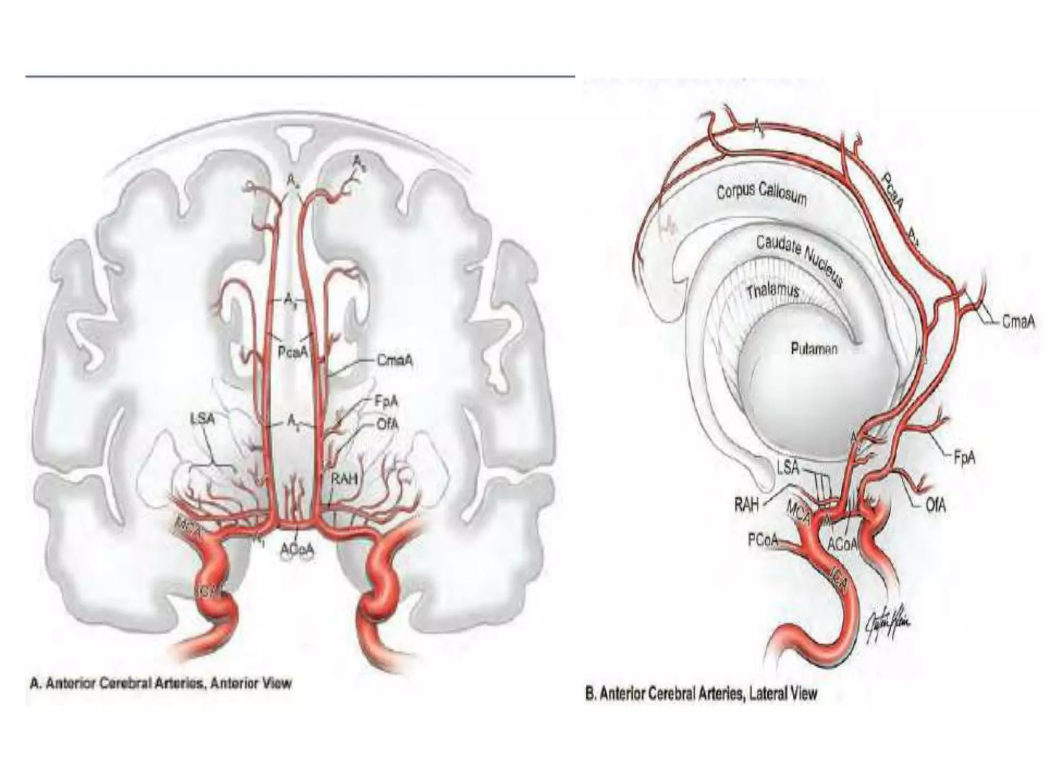Acom aneurysm | PPTX