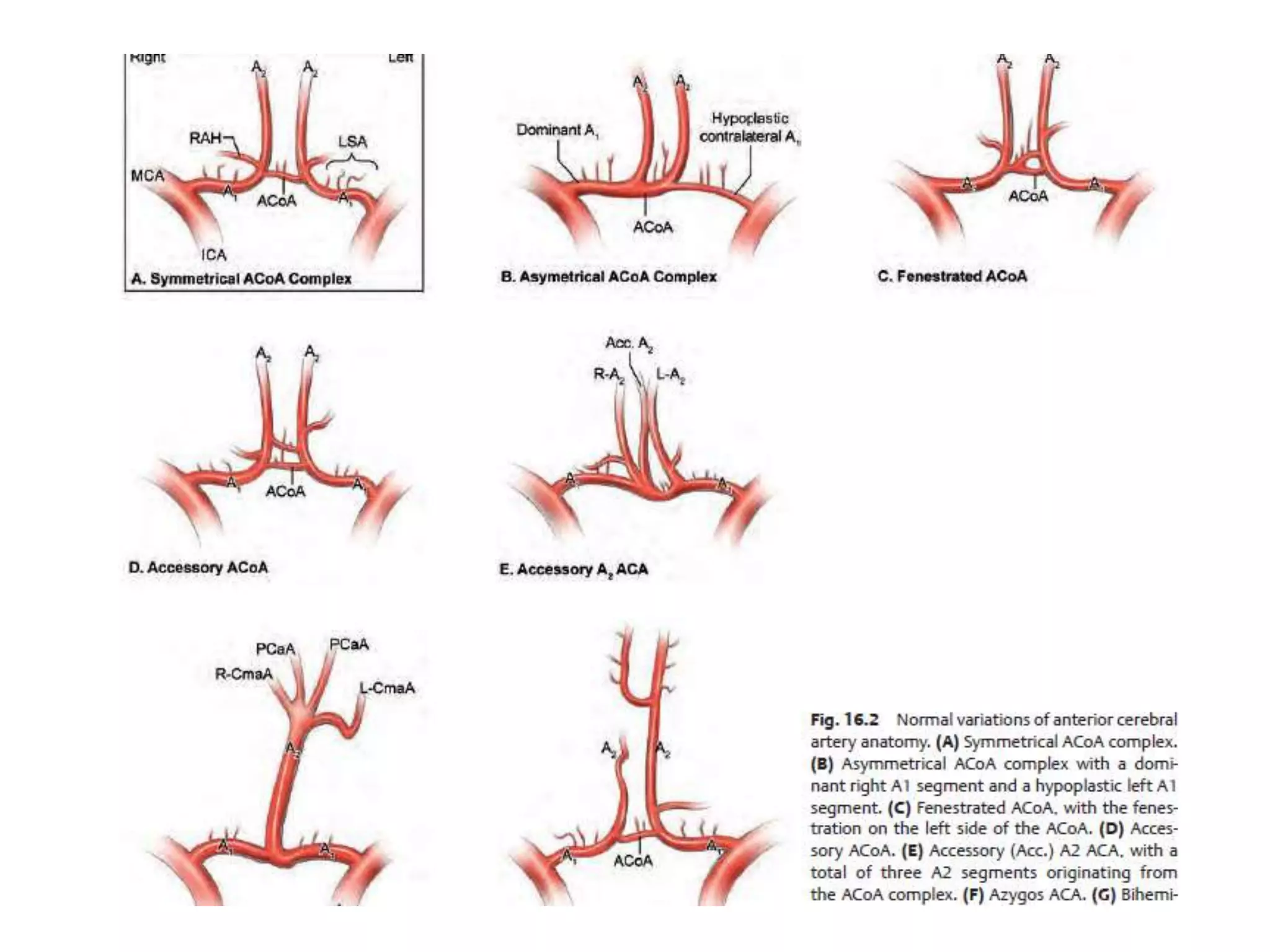Acom aneurysm | PPTX