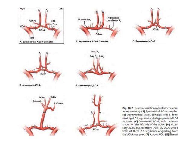 Acom aneurysm | PPTX