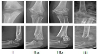 A comparison between percutaneous cross k wire and lateral k wires ...