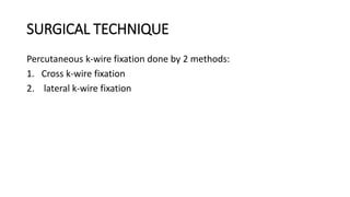 A comparison between percutaneous cross k wire and lateral k wires ...