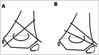A comparison between percutaneous cross k wire and lateral k wires ...