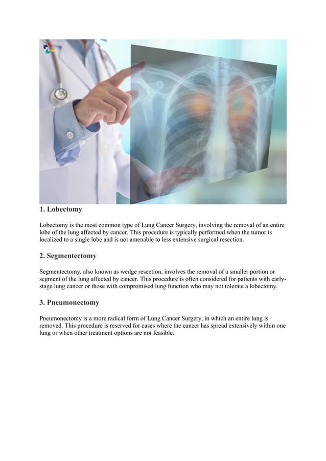 Lung Cancer Surgery: Types, Procedures, and Recovery | The Lifesciences ...