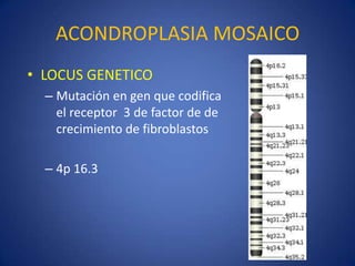 Acondroplasia | PPTX