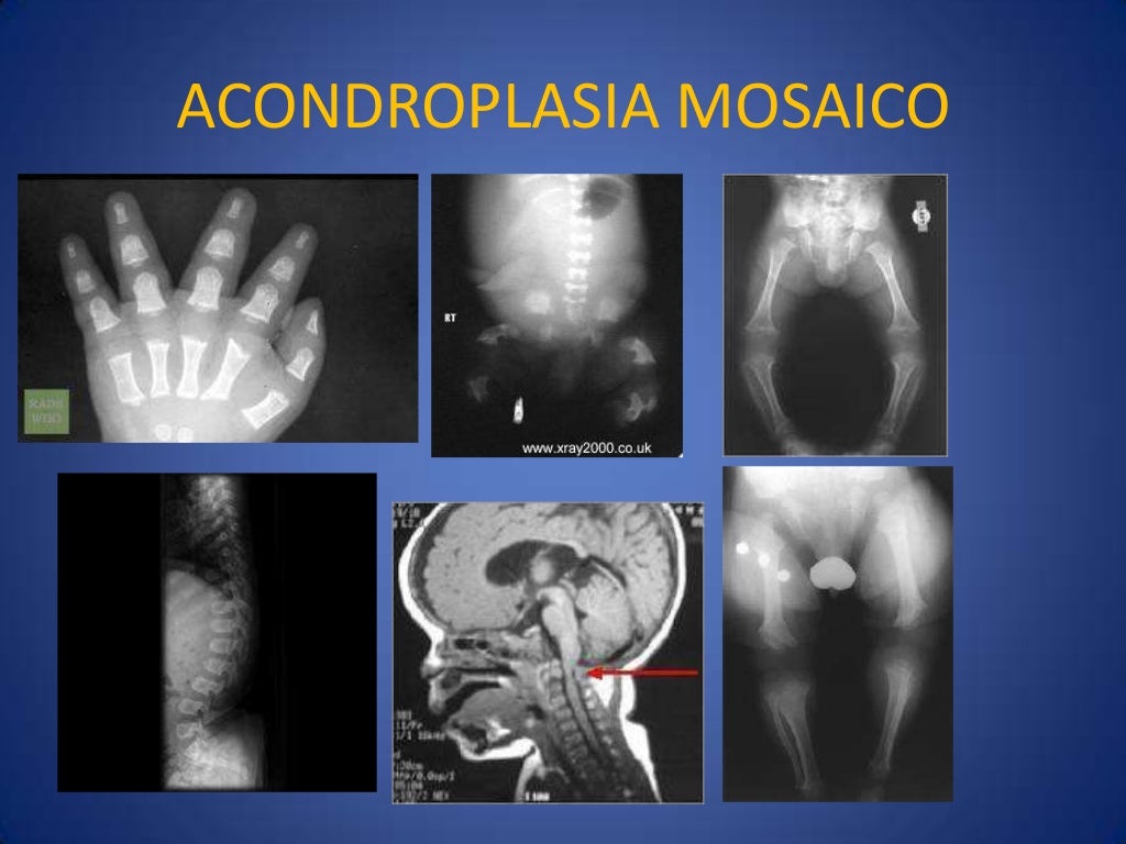 Acondroplasia