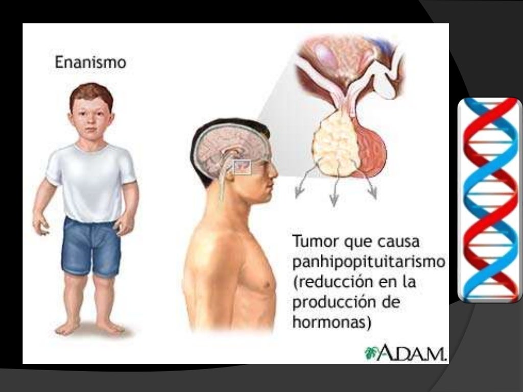 Acondroplasia
