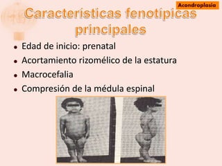 Acondroplasia | PPTX