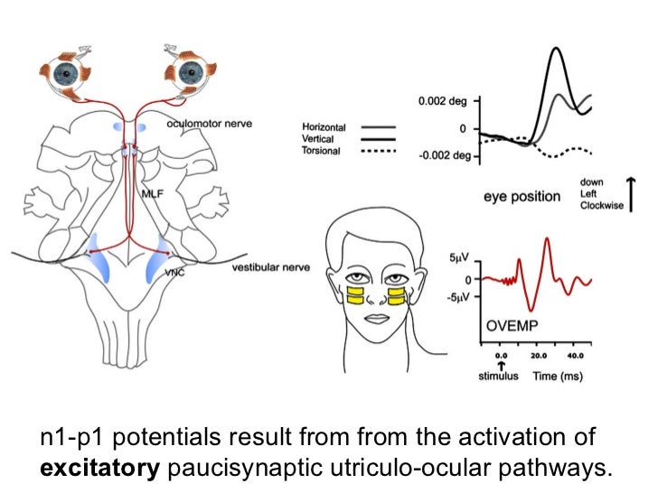 Acoustic neuroma