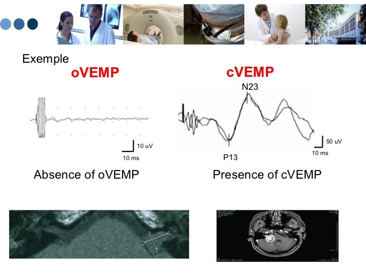 Potenziali Oculari Miogenici Evocati(o-VEMPs) da vibra zione per via ossea
