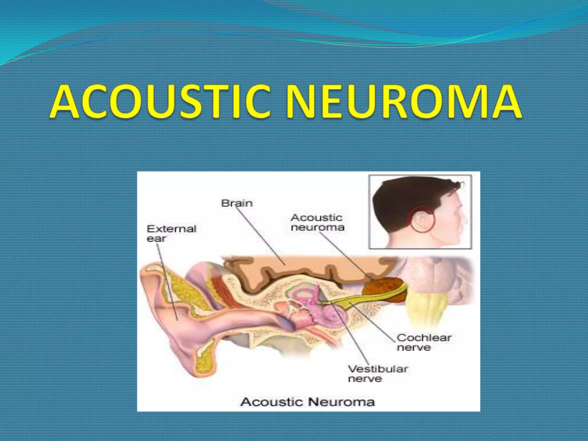Acoustic neuroma | PPTX