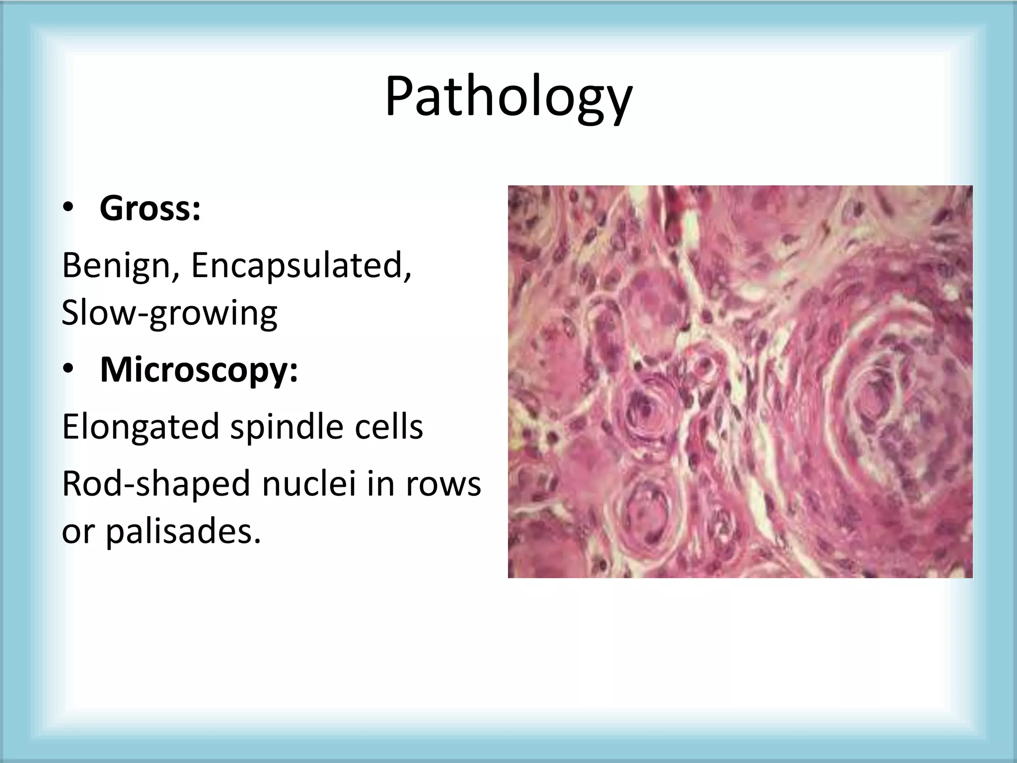 Acoustic neuroma | PPTX