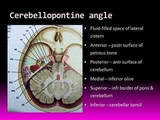 Cerebellopontine Angle Acoustic Neuroma