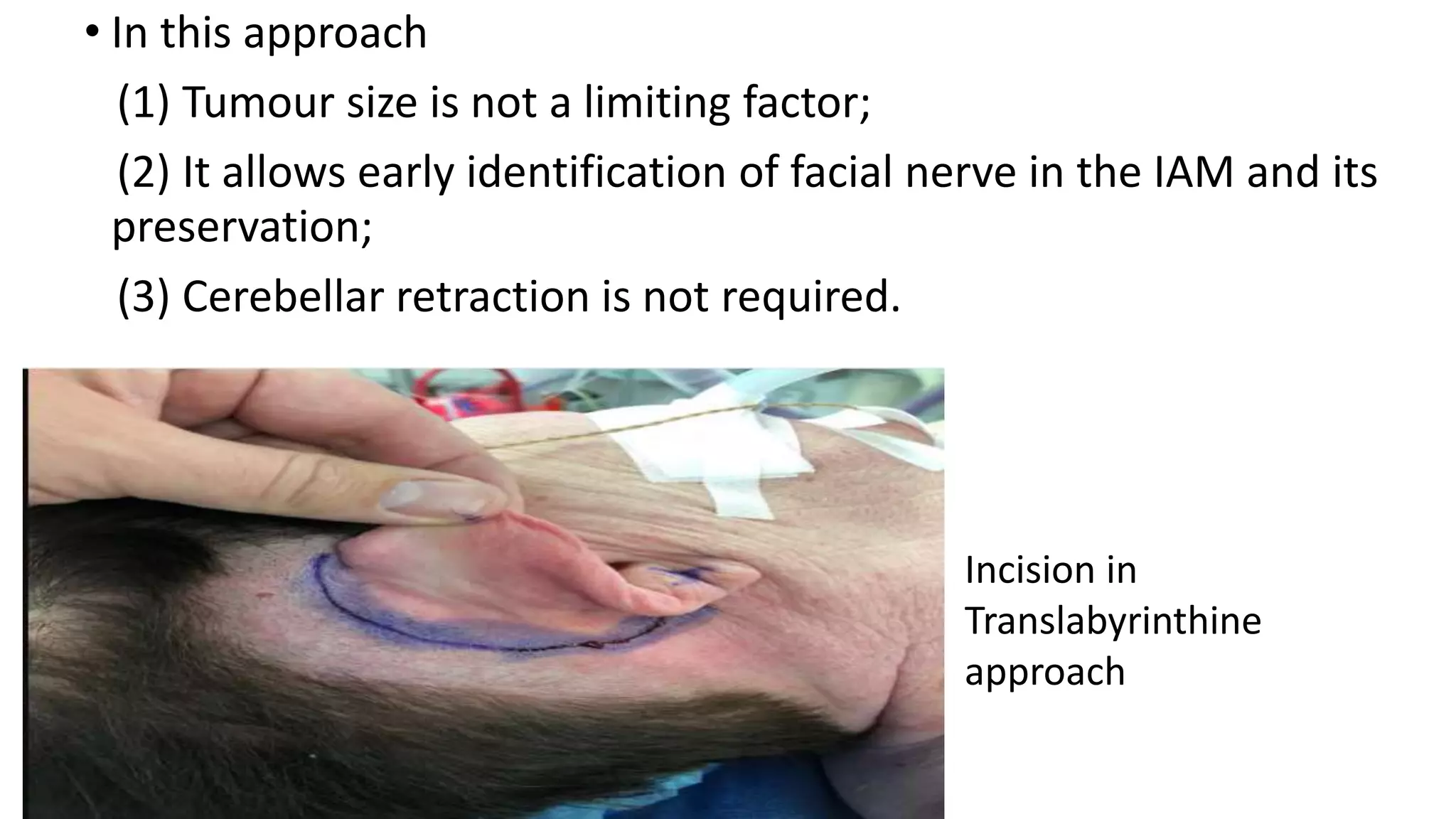 ACOUSTIC NEUROMA.pptx