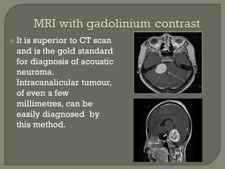 Acoustic neuroma ....,.................. | PDF