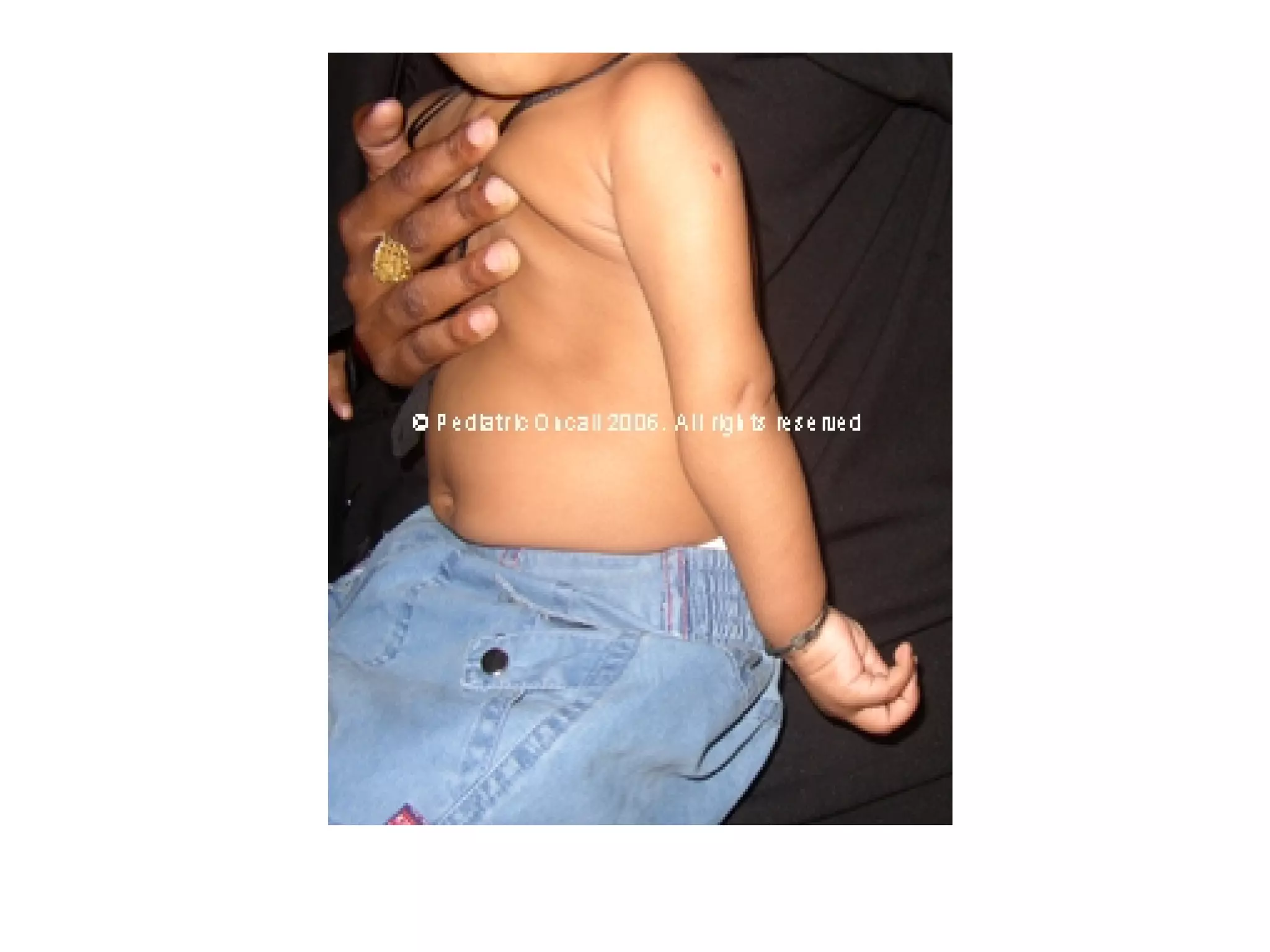 Acquired Bone Deformities | PPT