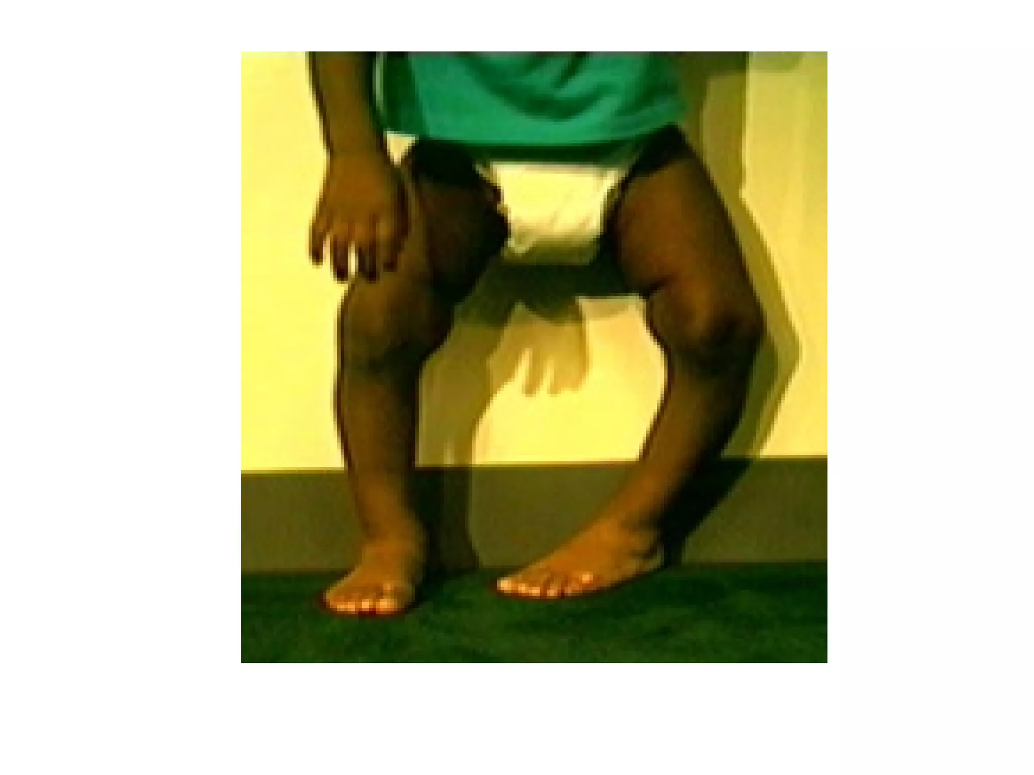 Acquired Bone Deformities | PPT