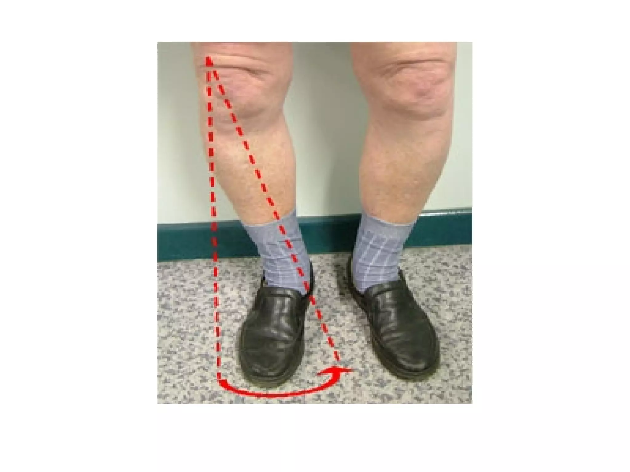 Acquired Bone Deformities | PPT