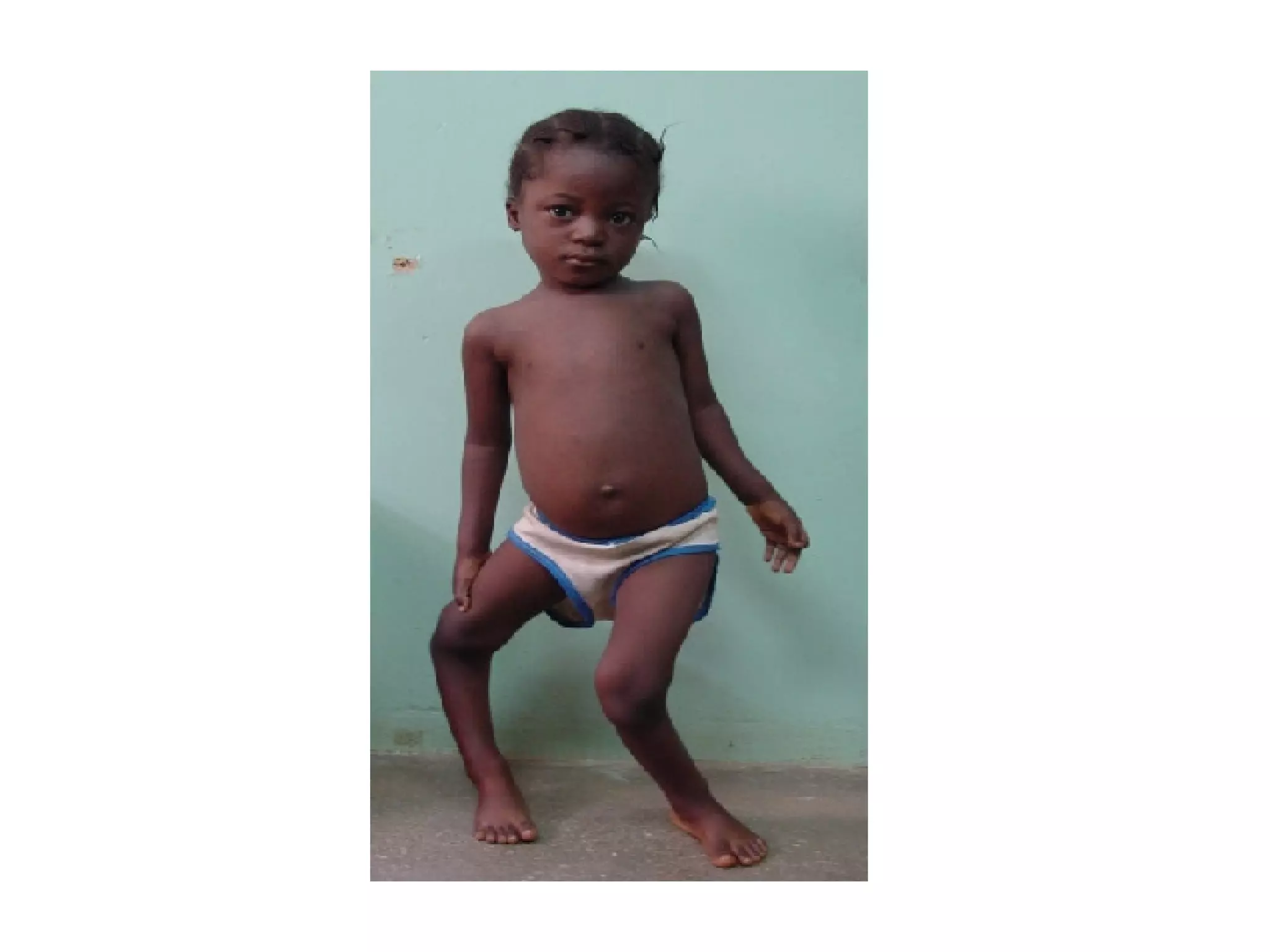 Acquired Bone Deformities | PPT