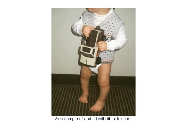 Acquired Bone Deformities | PPT | Bone and Joint Conditions | Diseases ...