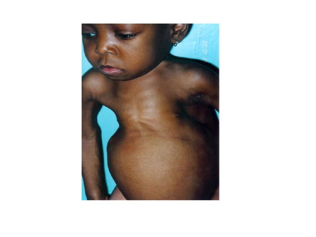 Acquired Bone Deformities | PPT | Bone and Joint Conditions | Diseases and Conditions