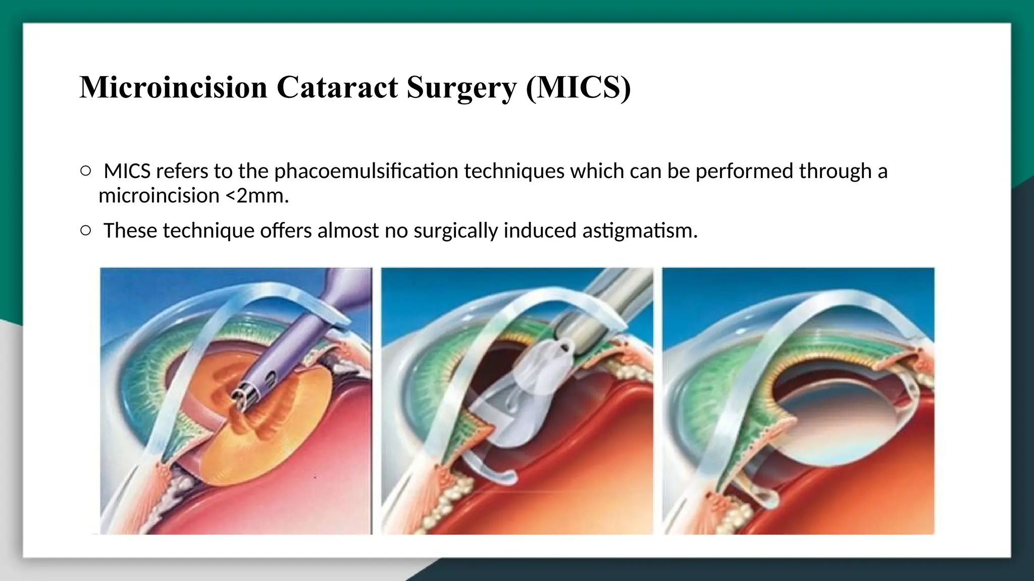 Acquired Cataracts: Causes, Symptoms, and Management.pptx