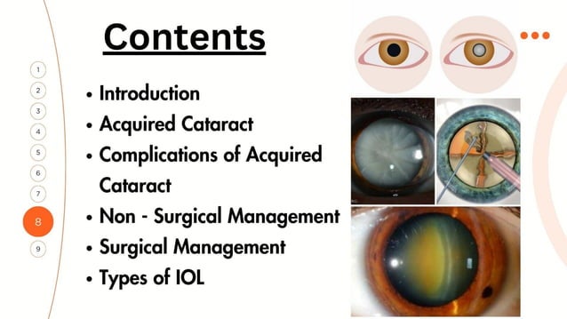 Acquired Cataracts: Causes, Symptoms, and Management.pptx