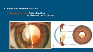 Acquired Cataract classification ,risk, mechanism and stages_mbbs.pptx