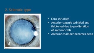 Acquired Cataract classification ,risk, mechanism and stages_mbbs.pptx