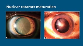 Acquired Cataract classification ,risk, mechanism and stages_mbbs.pptx