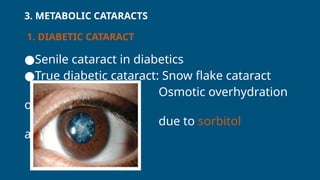 Acquired Cataract classification ,risk, mechanism and stages_mbbs.pptx
