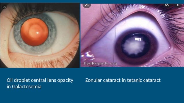 Acquired Cataract classification ,risk, mechanism and stages_mbbs.pptx