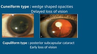 Acquired Cataract classification ,risk, mechanism and stages_mbbs.pptx