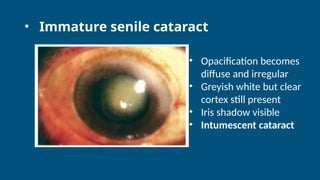 Acquired Cataract classification ,risk, mechanism and stages_mbbs.pptx