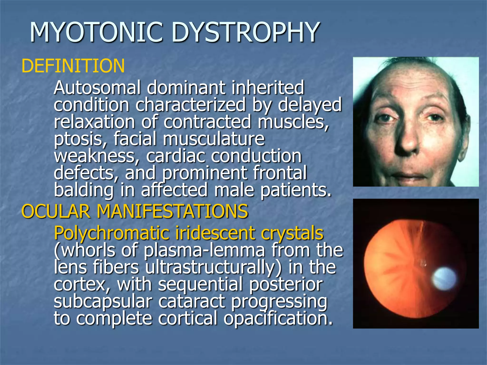 Acquired cataracts.ppt