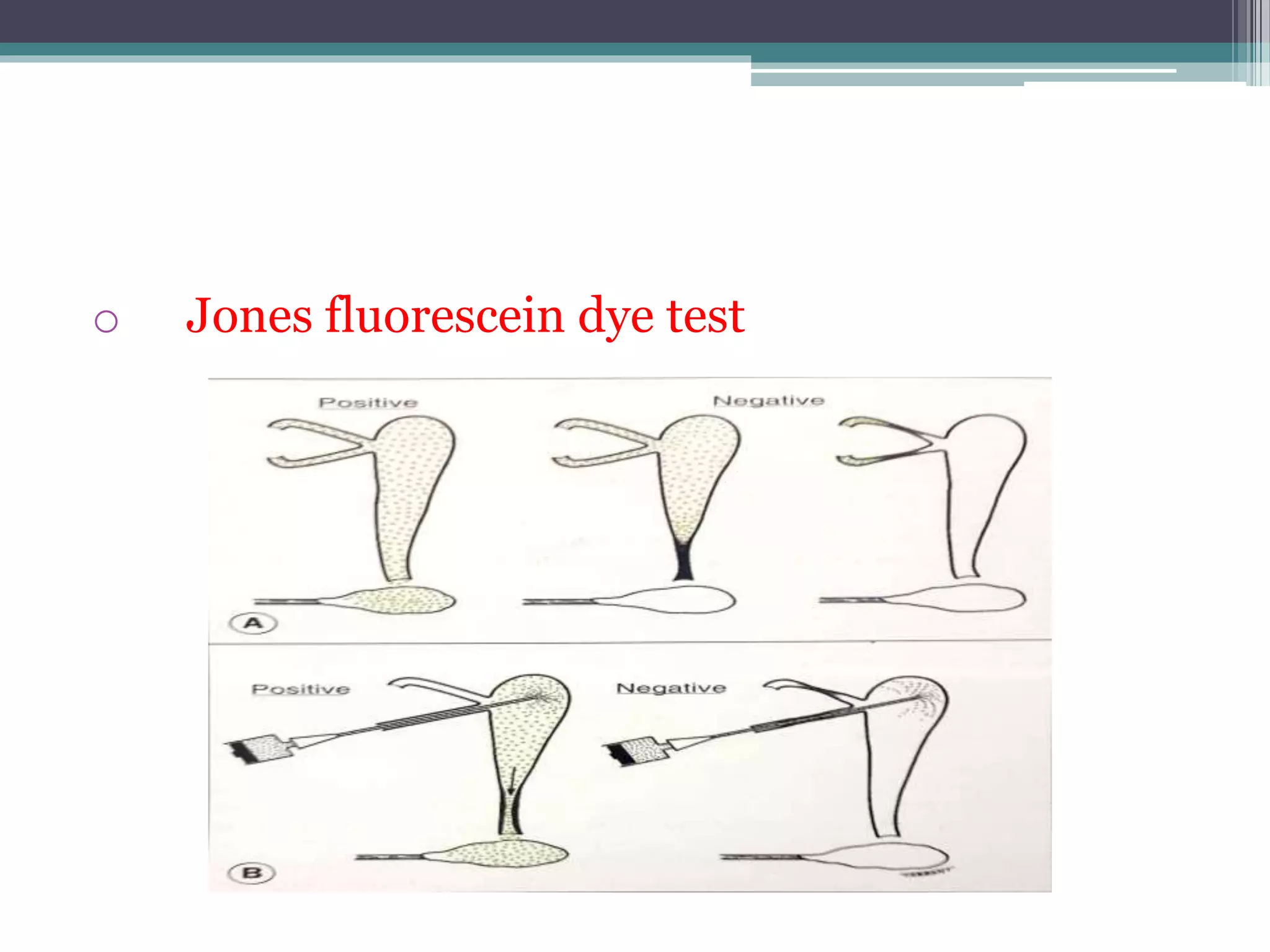 Acquired diseases of lacrimal drainage and management | PPTX