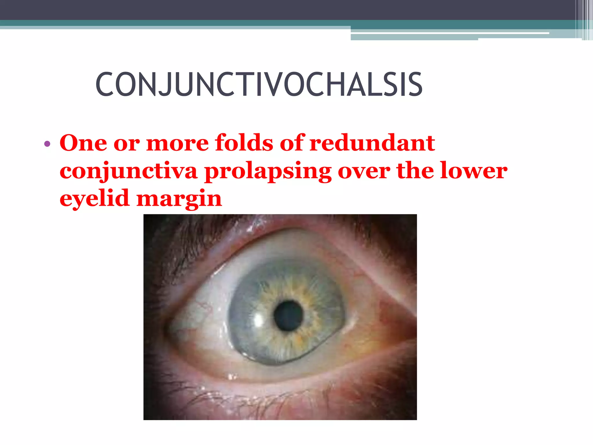 Acquired diseases of lacrimal drainage and management | PPTX