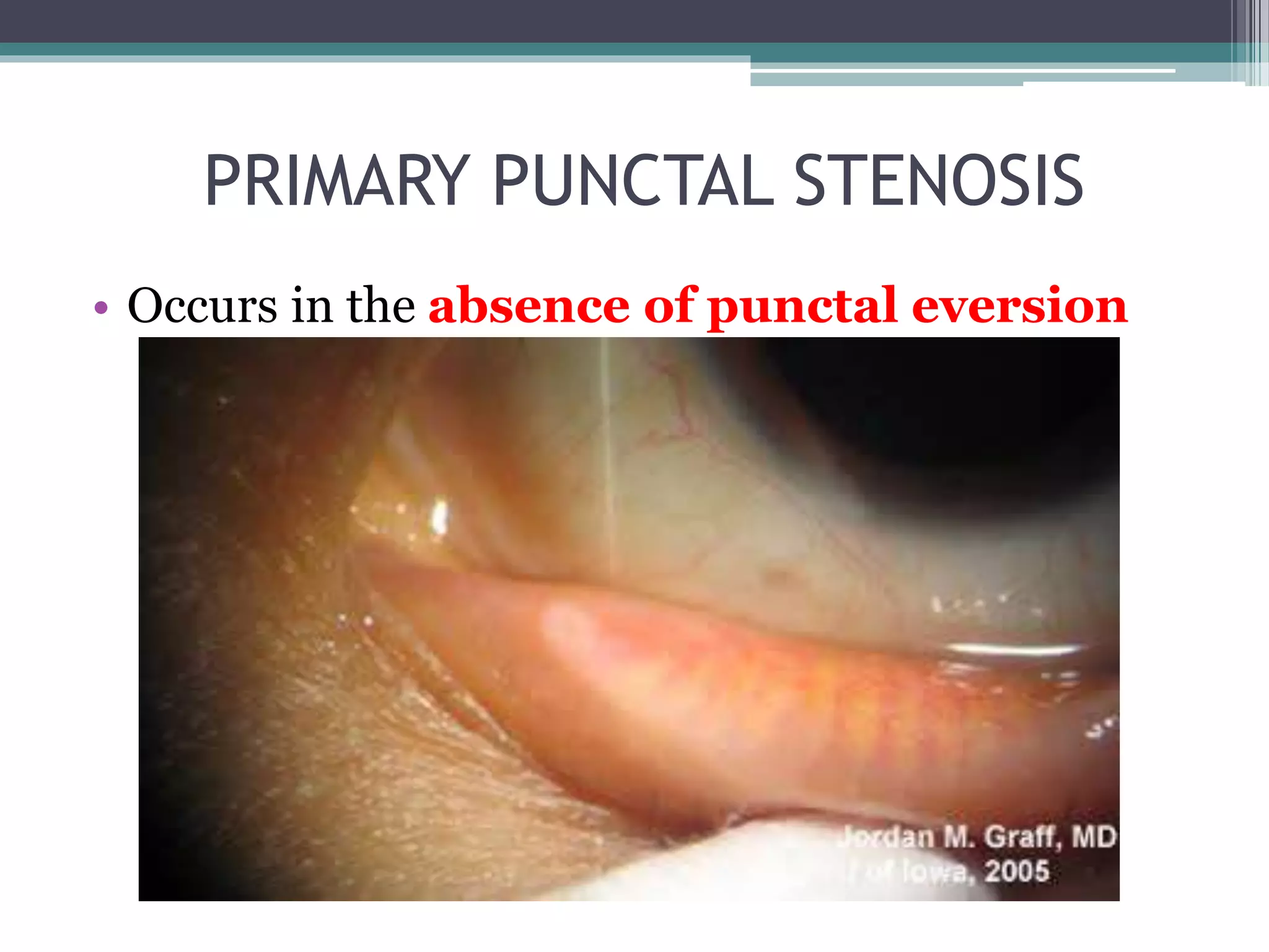 Acquired diseases of lacrimal drainage and management | PPTX