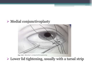 Acquired diseases of lacrimal drainage and management | PPT
