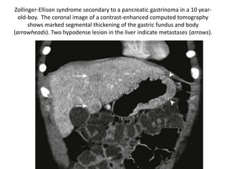 Acquired Disorders GIT child Radiology.pptx