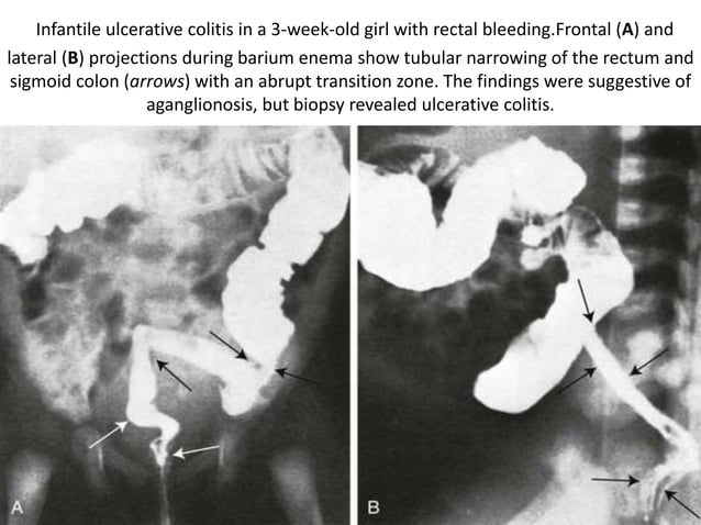 Acquired Disorders GIT child Radiology.pptx | Free Download