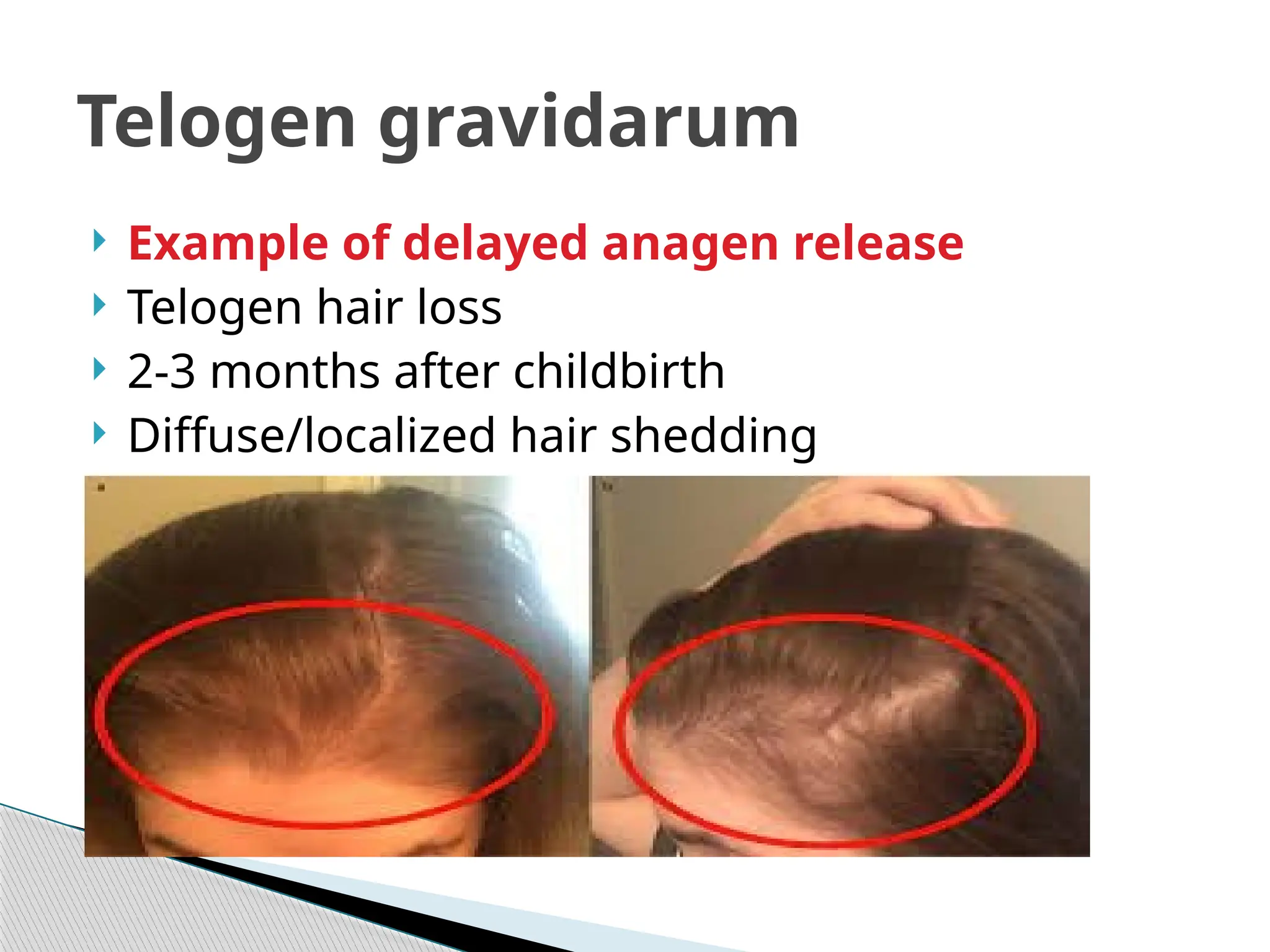 Acquired disorders of hair shaft by amna.pptx