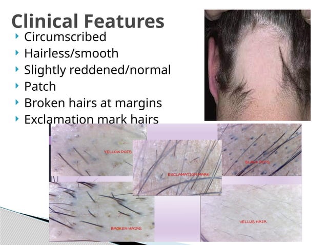 Acquired disorders of hair shaft by amna.pptx
